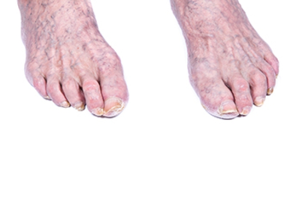 What Is Onychogryphosis?